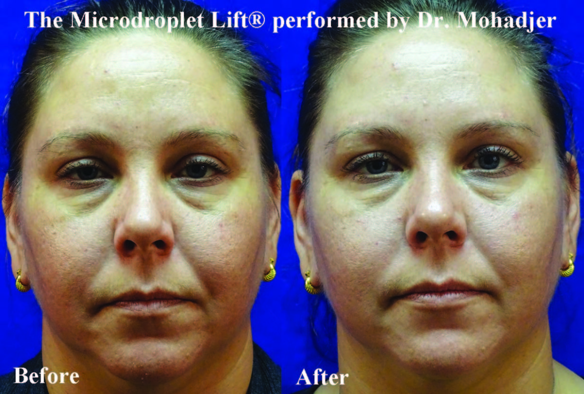 Microdroplet Lift® Welcomes Dr. Jasmine Mohadjer - Microdroplet Lift