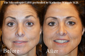 Whipple Before and After BOTOX.001 - Microdroplet Lift